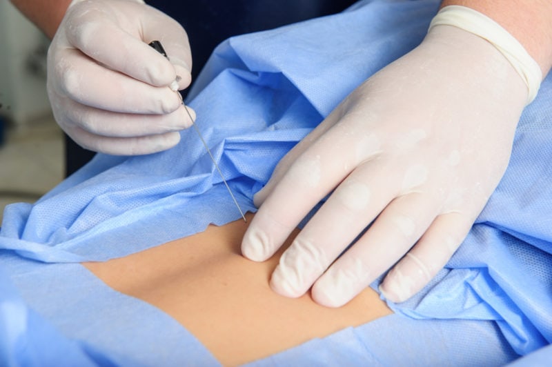 Back and Spine Doctor: Back Surgery Recovery Timeline - Howell Allen Clinic