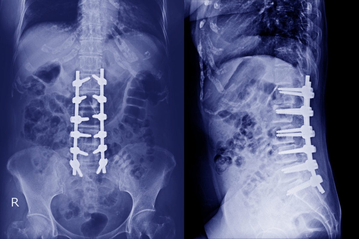 What Is Spinal Fusion Surgery and What Are the Benefits? - Howell Allen ...